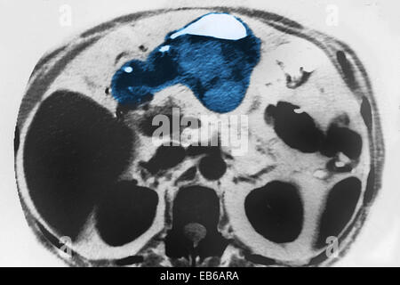 STOMACH CANCER, CT SCAN Stock Photo - Alamy