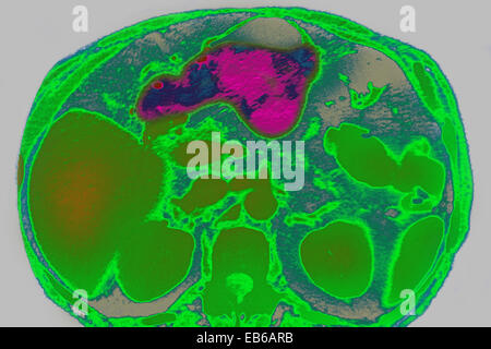 STOMACH CANCER, CT SCAN Stock Photo - Alamy