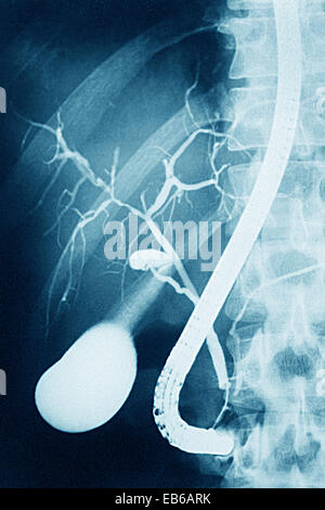 Gallbladder with bile duct and biliary tree 3D rendering illustration ...