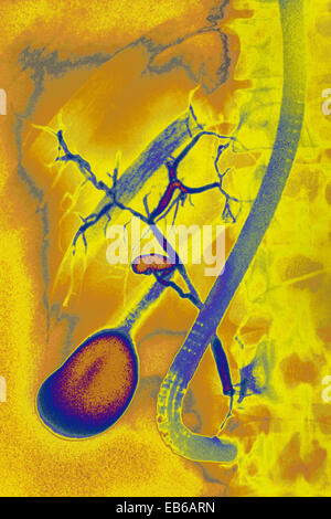 Gallbladder with bile duct and biliary tree 3D rendering illustration ...