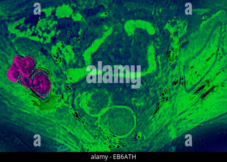 CT scan of Pelvic bone and hip joint 3D rendering for diagnosis ...
