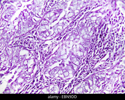 histological cut of tissue of lung cancer, 500 x Stock Photo - Alamy