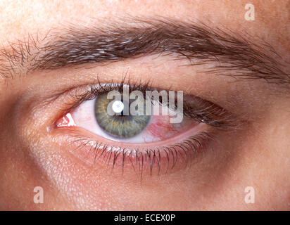 Close-up of irritated red eye with visible blood vessels and crusting ...