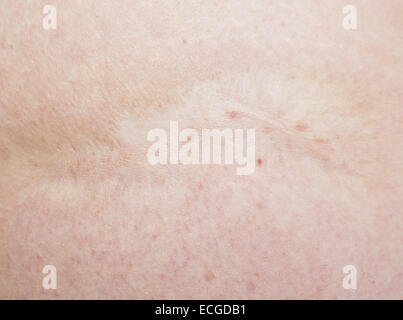close up of scar on human skin Stock Photo - Alamy