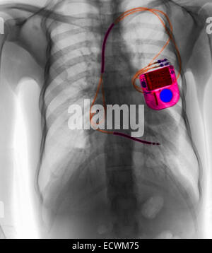 Chest x-ray showing pacemaker for atrial fibrillation Stock Photo - Alamy