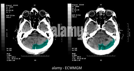 CT scan showing atrophy of both cerebral hemispheres Stock Photo - Alamy
