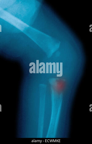 x-ray showing bone abnormalities seen in congenital syphilis Stock ...