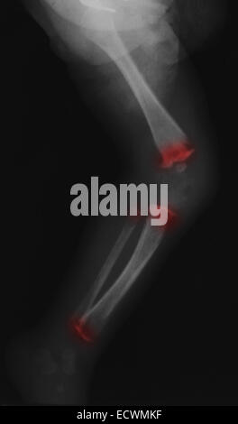 x-ray showing bone abnormalities seen in congenital syphilis Stock ...