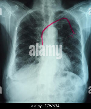 Chest xray showing infusion port into the heart Stock Photo - Alamy