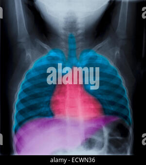 normal chest x-ray of a 3 year old boy Stock Photo - Alamy