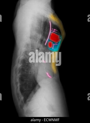 CXR with pacemaker for atrial fibrillation Stock Photo - Alamy