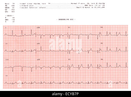 EKG showing normal sinus rhythm and an inferior infarct Stock Photo - Alamy