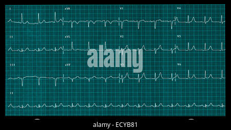 EKG showing normal sinus rhythm and an inferior infarct Stock Photo - Alamy