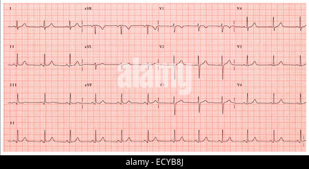 Normal electrocardiogram Stock Photo: 76818903 - Alamy