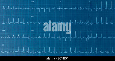 Abnormal electrocardiogram showing a sinus tachycardia Stock Photo - Alamy