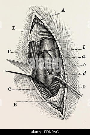 ligature, medical equipment, surgical instrument, history of medicine ...