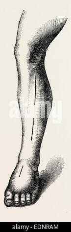 ligature, medical equipment, surgical instrument, history of medicine ...