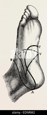 inner and outer sides of the right foot, to show the incisions, medical ...