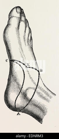 inner and outer sides of the right foot, to show the incisions, medical ...
