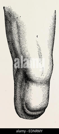 the stump, medical equipment, surgical instrument, history of medicine ...