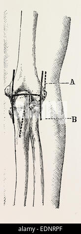 excision, medical equipment, surgical instrument, history of medicine ...