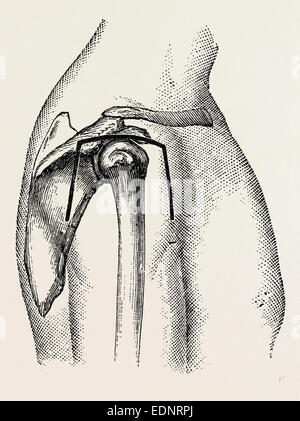 excision, medical equipment, surgical instrument, history of medicine ...