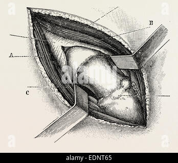 excision of the hip by an external incision, medical equipment ...