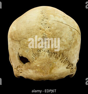 Human Skull Fracture (backside) (Mongoloid,Asian) on isolated ...