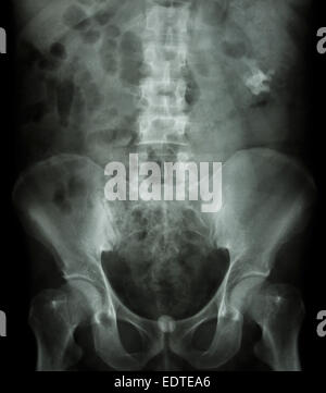 Kidney calcification. X-ray of the abdomen of a patient with ...