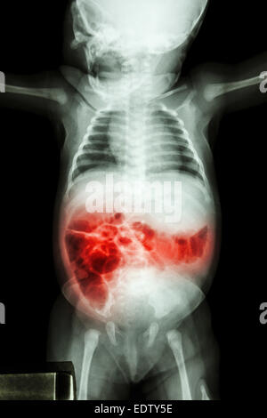 Enteritis (X-ray of sick infant and inflammation of intestine Stock ...