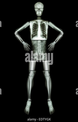 X-ray chest ( akimbo position ) ( front view Stock Photo - Alamy