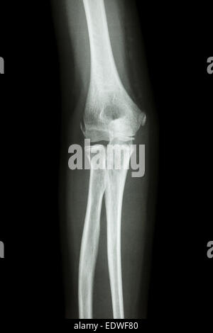 Xray image of Humerus Bone AP and Lateral view Stock Photo - Alamy