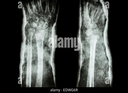 X ray Colles fracture Stock Photo - Alamy