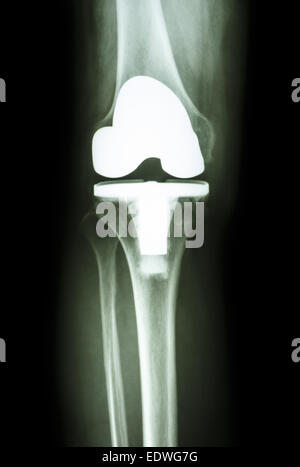 X-ray image of an artificial knee joint Stock Photo: 20322783 - Alamy