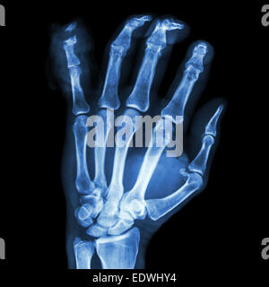 Film X-ray show fracture distal radius (Colles' fracture) (Wrist Stock ...