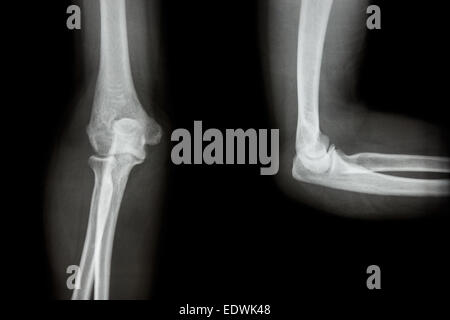 film x-ray elbow AP/Lateral : normal human's elbow Stock Photo - Alamy