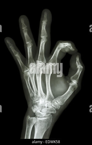 Xray right hand x-ray Stock Photo - Alamy