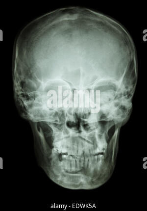 film x-ray skull AP : show normal human's skull Stock Photo - Alamy