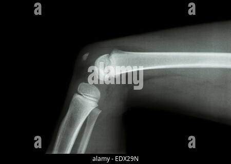 CHILD KNEE, X-RAY Stock Photo: 49270541 - Alamy