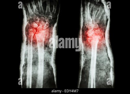 Colles fracture, X-ray Stock Photo - Alamy
