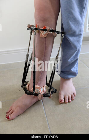 External fixator fitted to a leg to help hold it in the correct ...