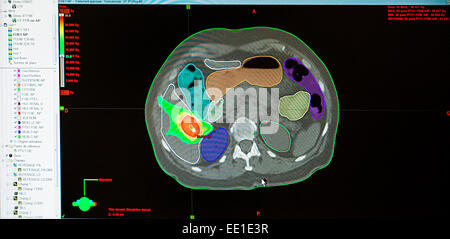 Liver cancer radiotherapy. Illustration of radiotherapy for treatment ...