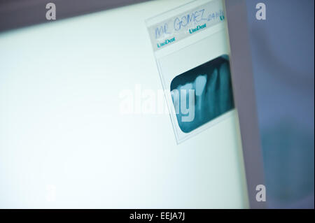 Dental X-ray image showing dental amalgam Stock Photo - Alamy