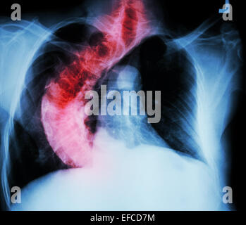 Scoliosis ( crooked spine ) X-ray chest of old people with crooked ...