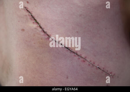 Scar with staples following a partial nephrectomy operation on right ...