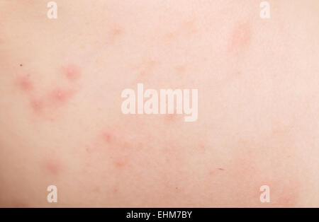 rash on human skin Stock Photo - Alamy