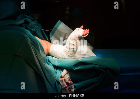 Laying a cast after hand surgery Stock Photo - Alamy