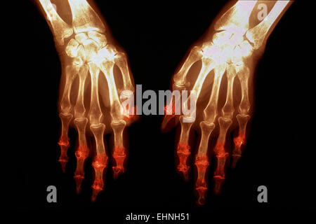 Arthritic hands. Coloured X-ray of hands suffering from severe ...