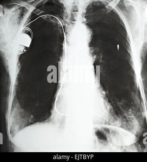 Chest x ray cardiac pacemaker in situ Stock Photo: 2835534 - Alamy