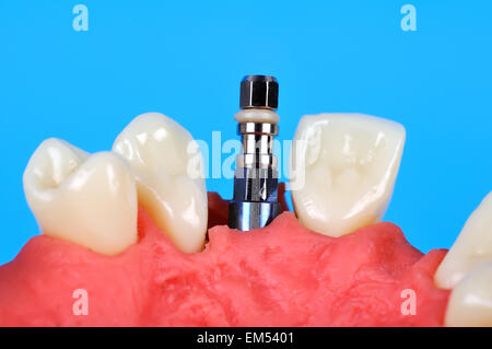 Dental implant implanted in jaw bone, close up Stock Photo - Alamy